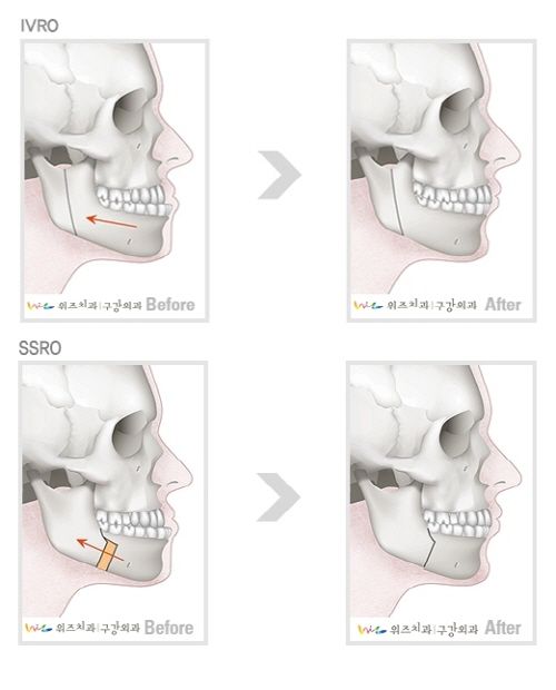 안면비대칭 양악수술, 'IVROㆍSSRO' 혼용 필요